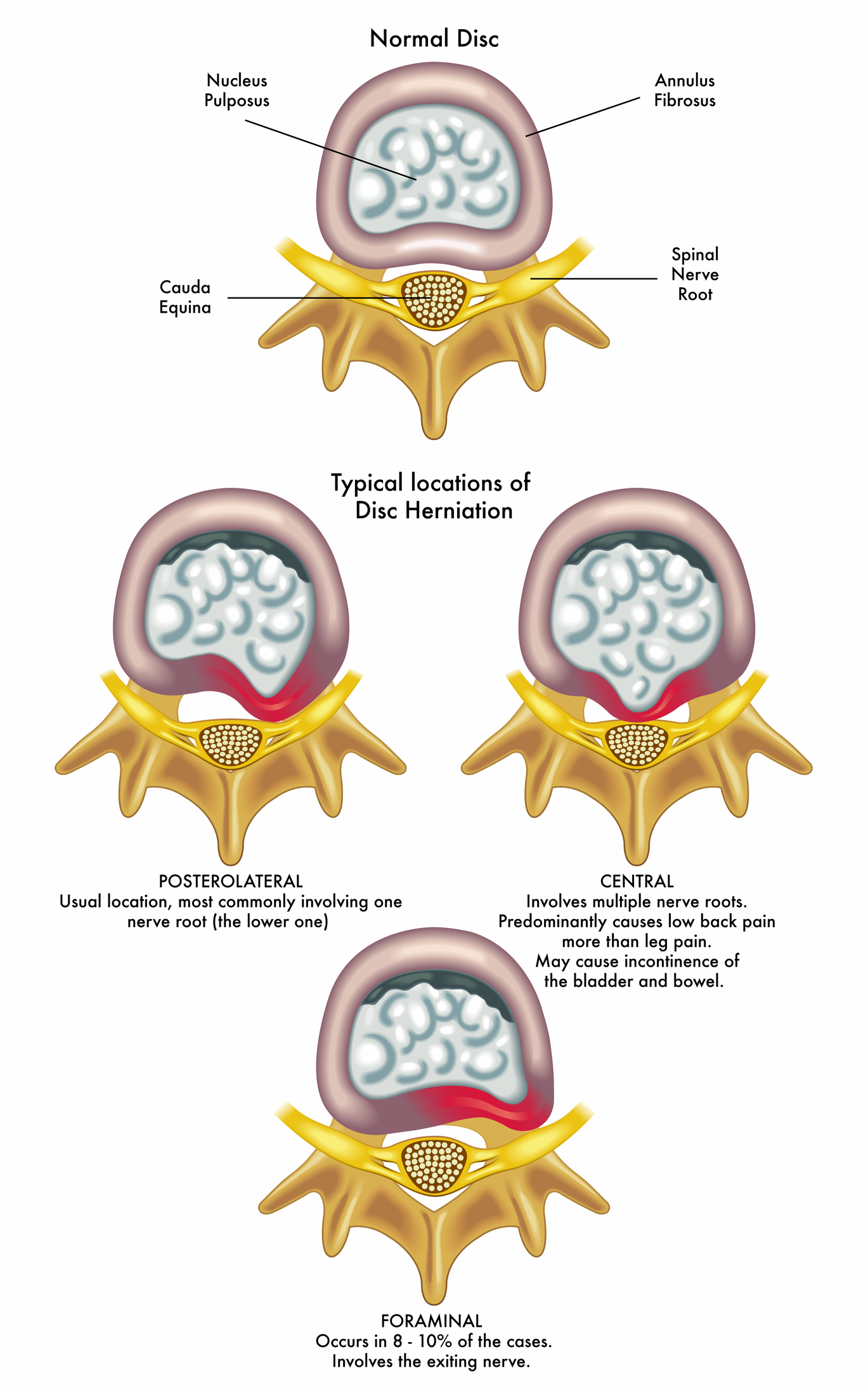 Slipped Disc Which Treatment Integrated Chiropractic Acupuncture Slipped Disc Which Treatment Integrated Chiropractic Acupuncture